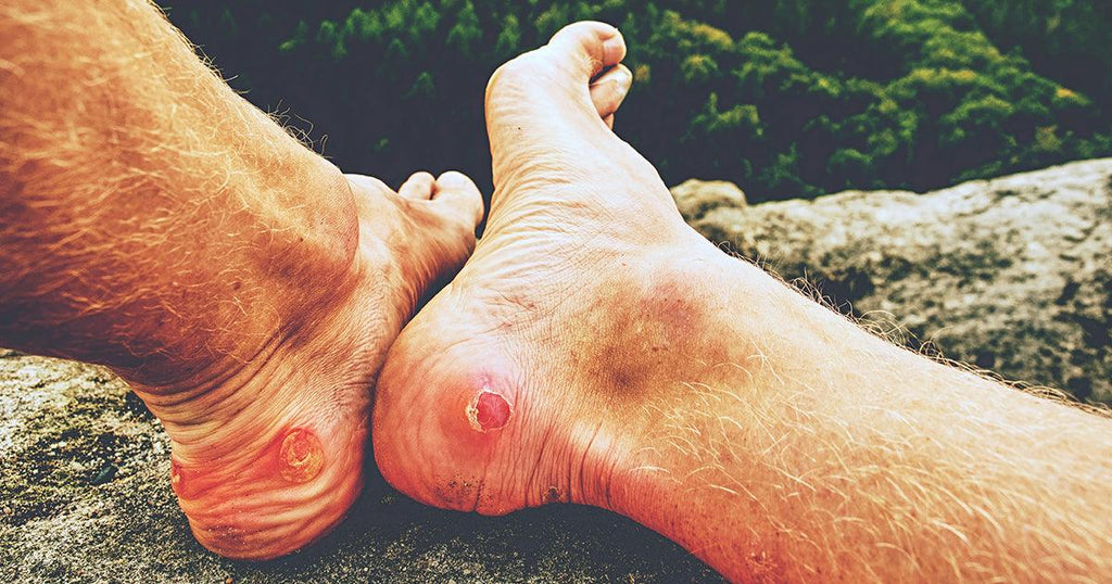 How To Manage And Prevent Running Blisters On The Feet?